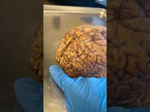 Seizures and the Brain
