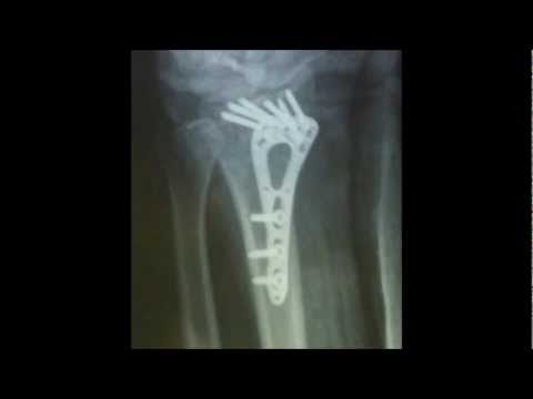 Titanium Bone Plates - Titanium Bone Reconstruction Plates Latest Price ...