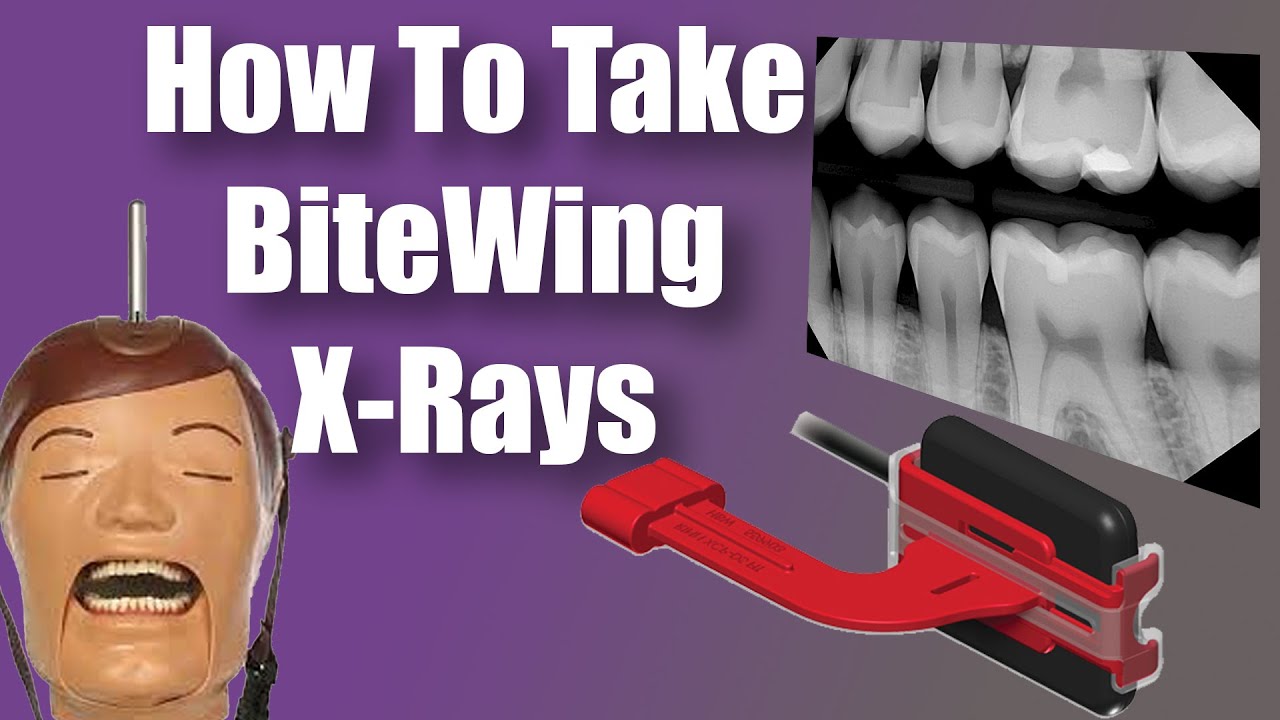 Bitewings X Rays - Dental Tips and Tricks