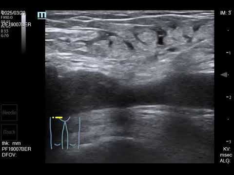 Double lumen for emergent dialysis