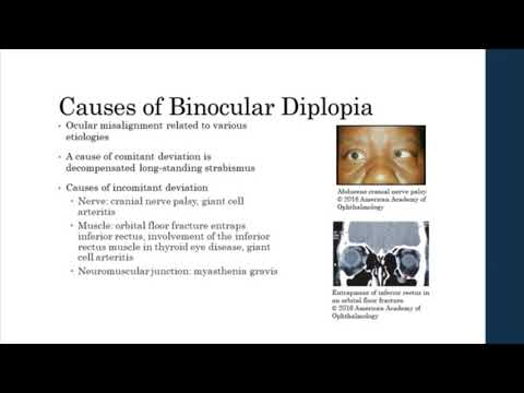 Binocular vs. Monocular Diplopia