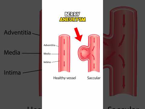Are there DIFFERENT types of aneurysms? #brain #doctor #health #medicine #medstudent #doctors #fyp