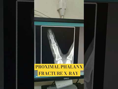 Rt. Hand proximal Phalanx Fracture #xray #fracture #viralshorts #fractures #radiologycareer #viral