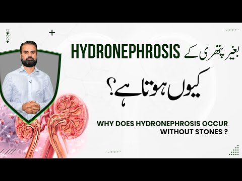 Pathri Ka Bagair Hydronephrosis | Hydronephrosis Without Kidney Stone Causes & Treatment in Urdu