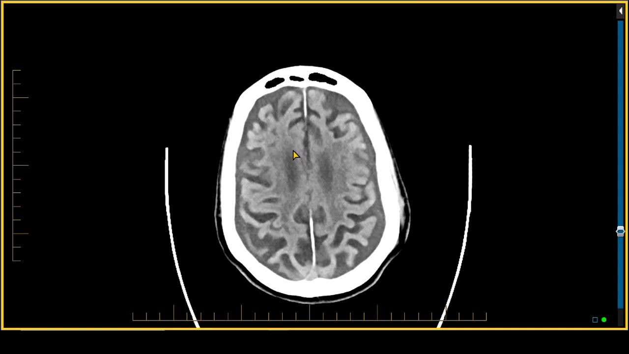 Bilateral Chronic Subdural Hematoma   MRI Online