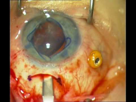 Cataract nightmare or sweet dreams