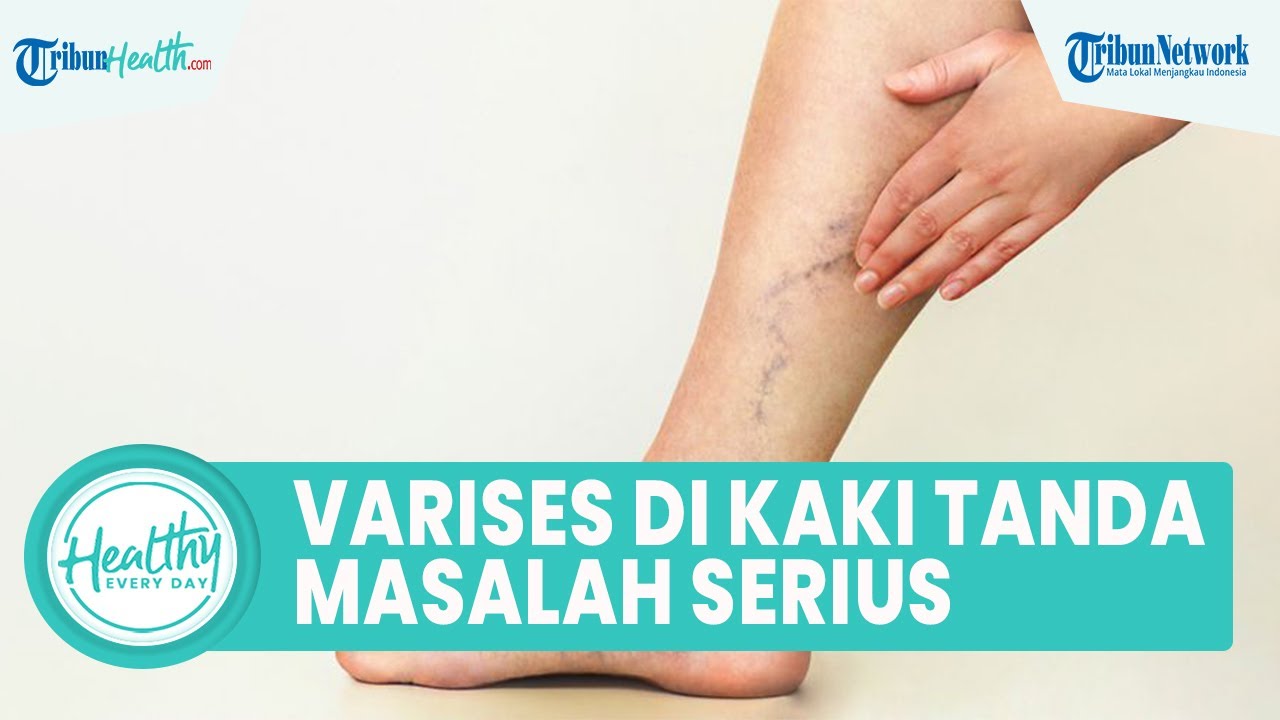 Jangan Disepelekan! Varises pada Kaki Bisa Jadi Masalah Serius ...