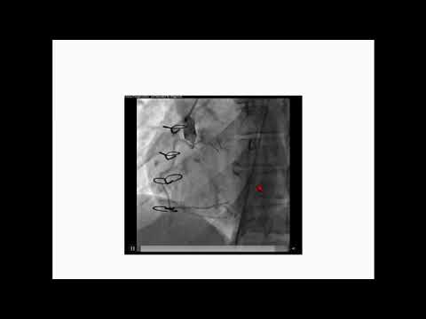 CVI2017 Challenging Case: My Institution's Interesting STEMI - Amir Solhpour, MD