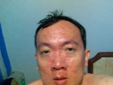 Cacar Air yg ke-2 (SOLUSInya....klik: Http://youtu.be/gT3qC2HMC58)