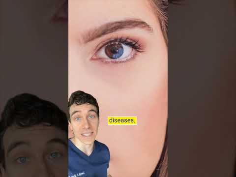 Heterochromia - Eye Doctor Explains #eyecolor