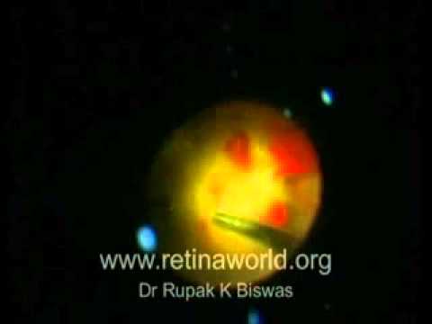 TRACTIONAL RETINAL DETACHMENT SURGERY
