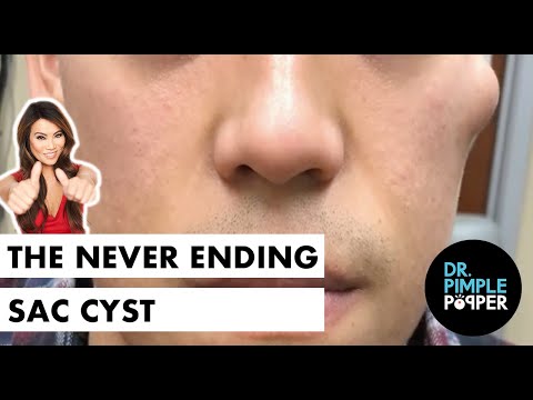 Dr. Pimple Popper Pops 'Never Ending Sac Cyst' In New YouTube Vid