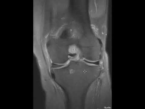 Discoid meniscus