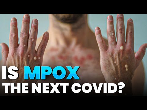 Is Monkeypox the Next COVID-19? (2024)