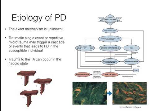 Peyronie's Disease: An Update to Clinical Practice Guidelines