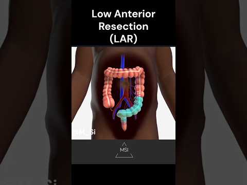 Low Anterior Resection (LAR)