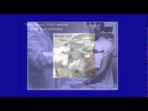 Rotator Cuff Tears