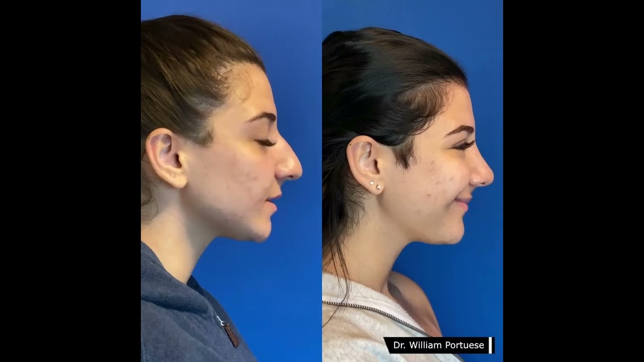 Rhinoplasty Results - Watch the Droopy Tip Disappear
