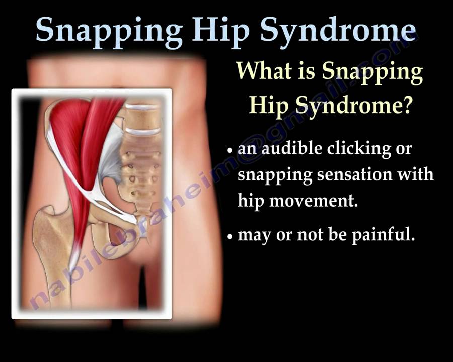 Snapping Hip Syndrome - Everything You Need To Know - Dr. Nabil Ebraheim