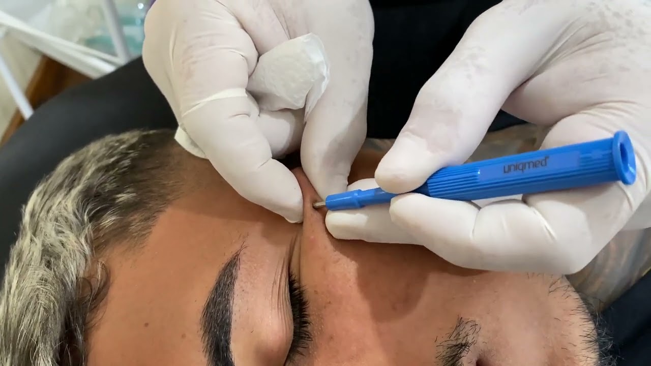 Como Aplicar um microdermal no rosto