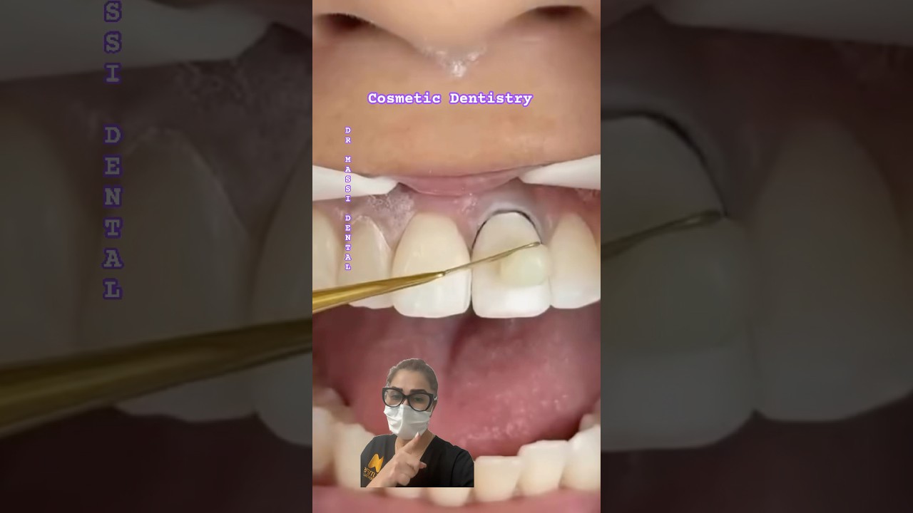 SMILE Composite Veneers not expensive
