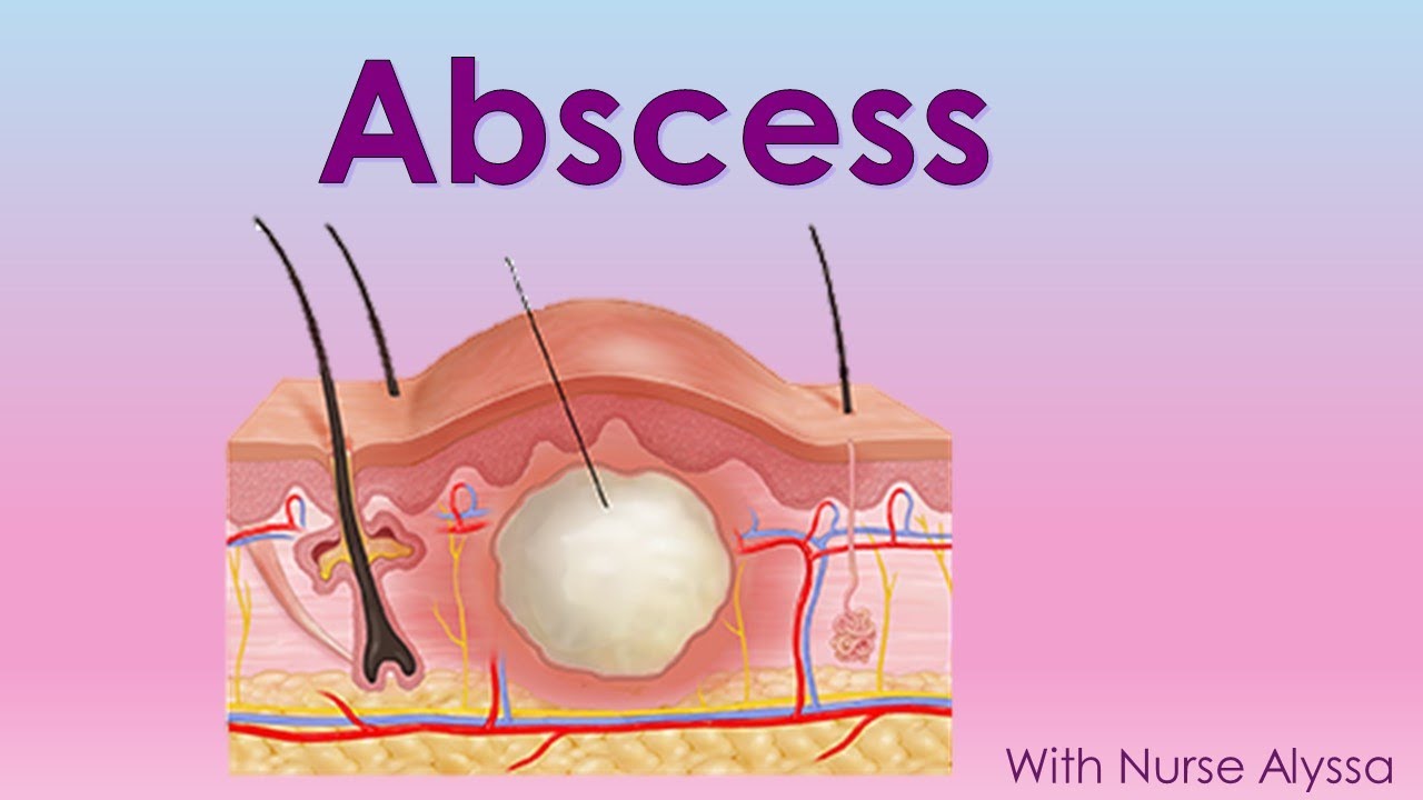 Abscess: Everything you should know