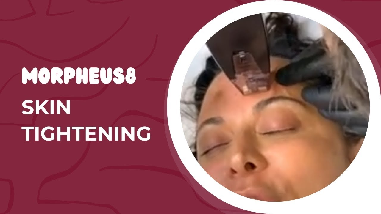 Morpheus8 | Skin Tightening | West Hollywood, CA | Dr. Jason Emer