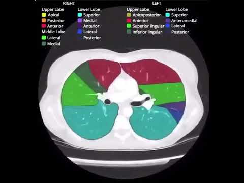 How to recognize lung segments on chest CT ?