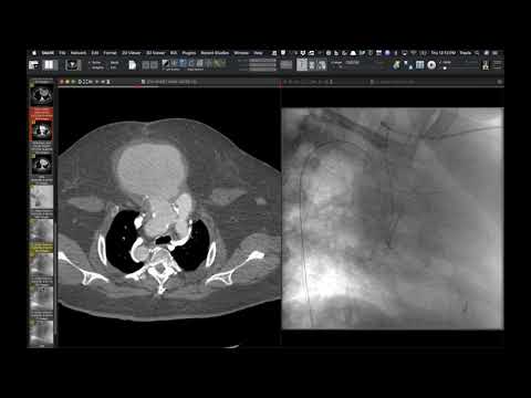 STR Cardiothoracic Case Webinar 12/27/2018