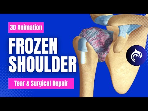 Frozen Shoulder (Adhesive Capsulitis)