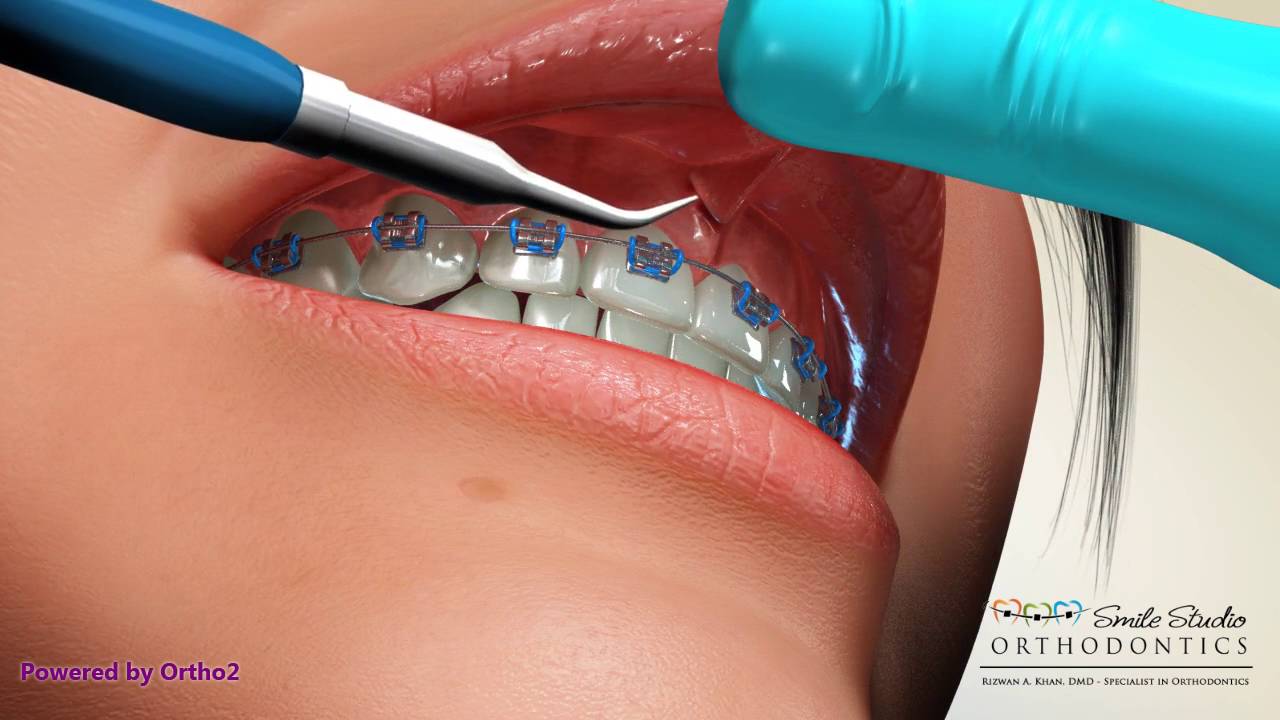 Frenectomy - Orthodontic Procedures