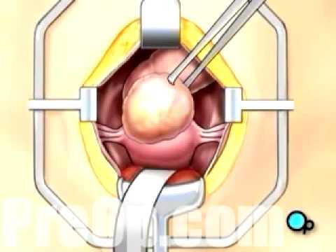 PreOp® Patient Education Myomectomy Abdominal Fibroid Removal Surgery