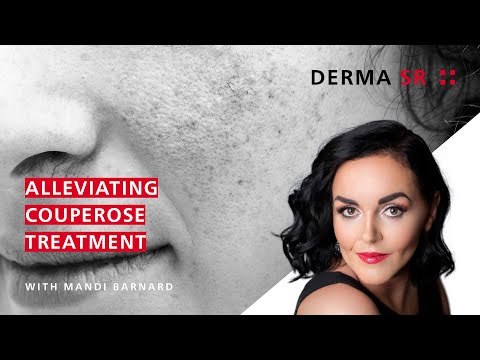 Alleviating Couperose and Rosacea with Highly Effective Skincare