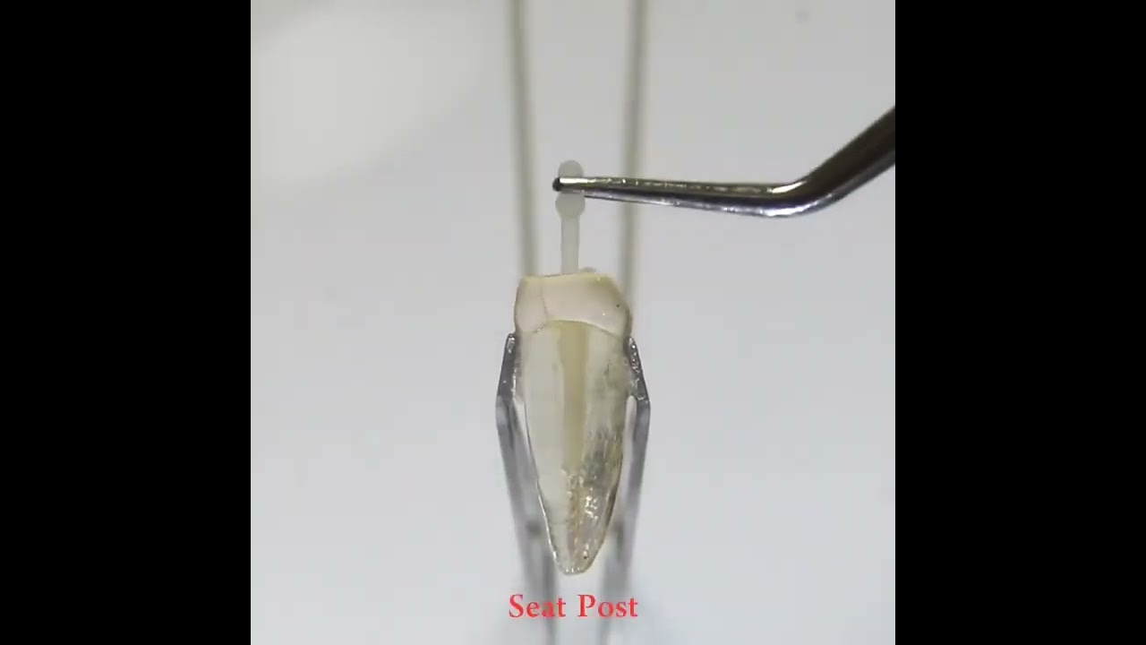 Pesso Reamer and Fiber Post