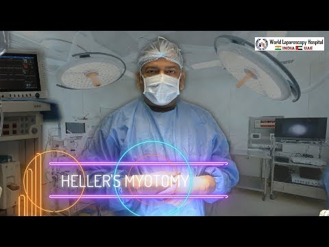 Laparoscopic Heller's Myotomy with Appendectomy • Video • MEDtube.net