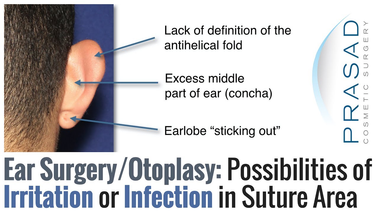 Possibilities of Suture in Otoplasty (Cosmetic Ear Surgery) Causing Irritation or Infection