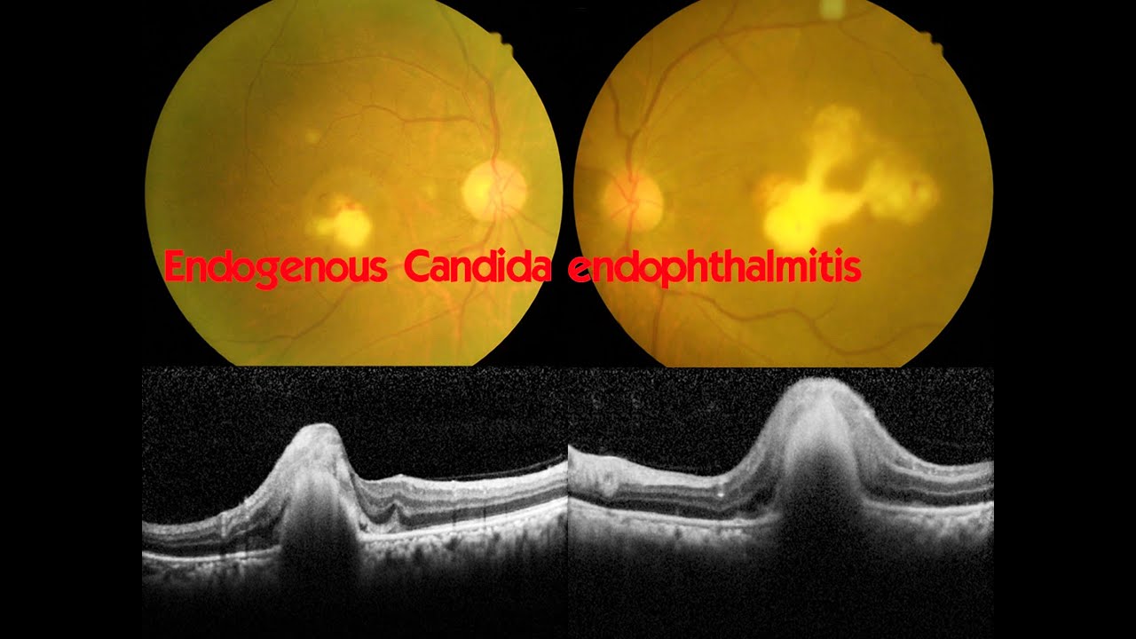 Endogenous Candida endophthalmitis #KanskiSeries