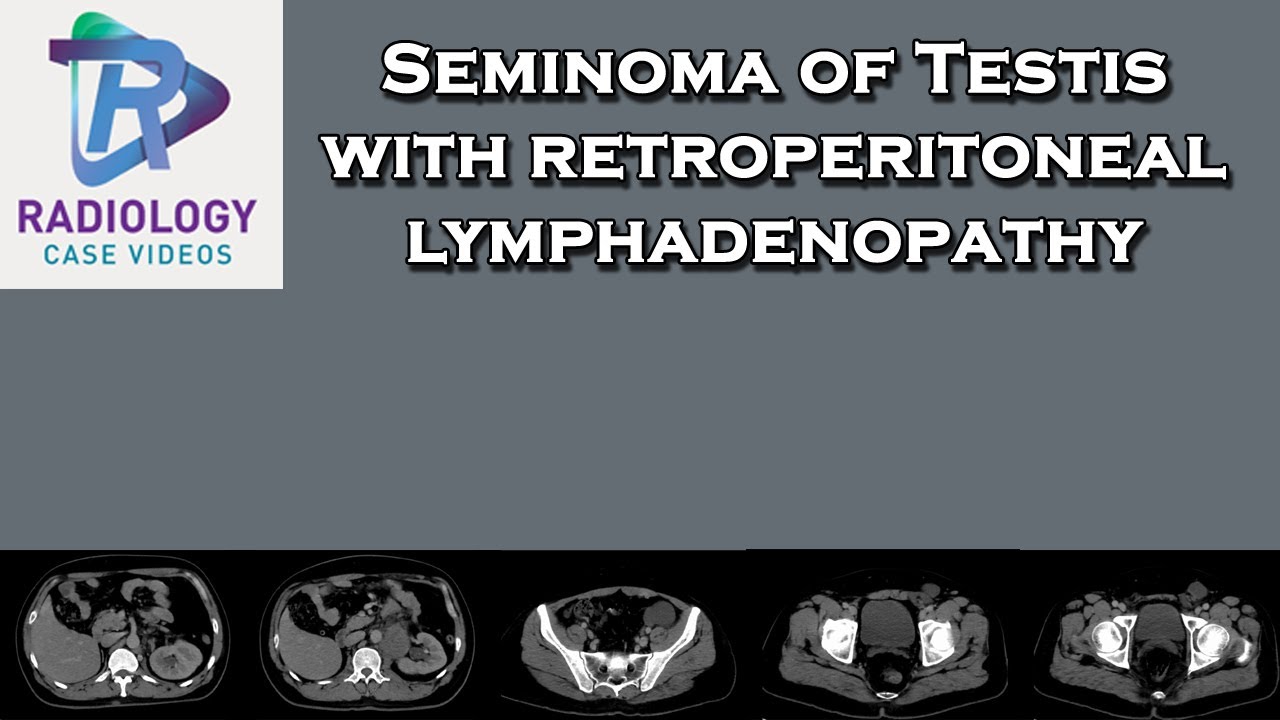 Seminoma of Testis with retroperitoneal lymphadenopathy
