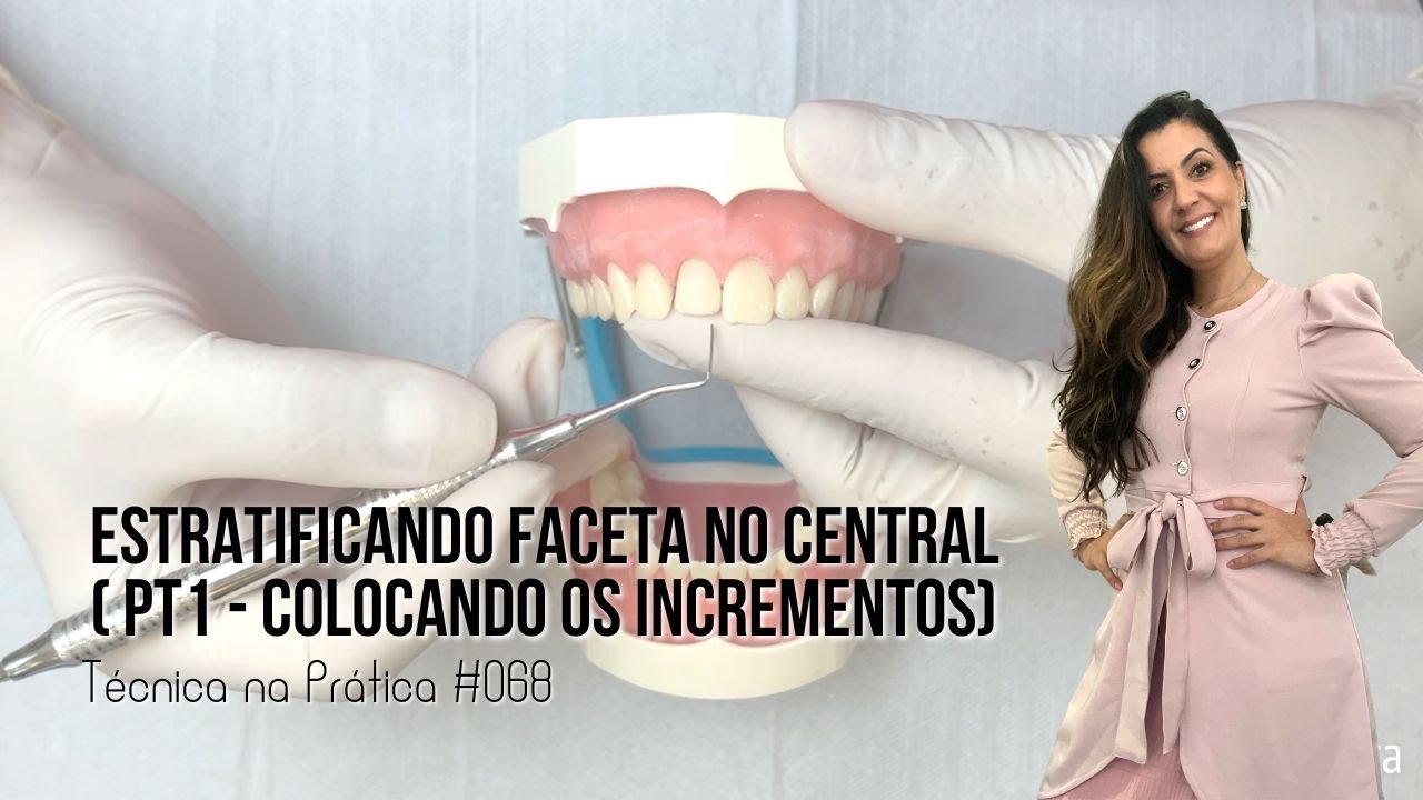 Estratificando Faceta de Resina no Central || Pt1- Incrementos de Resina