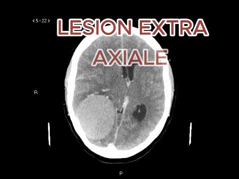 INTRA VS EXTRA AXIALE  #radiologystudent #hospitalityeducation  #femmemedecine
