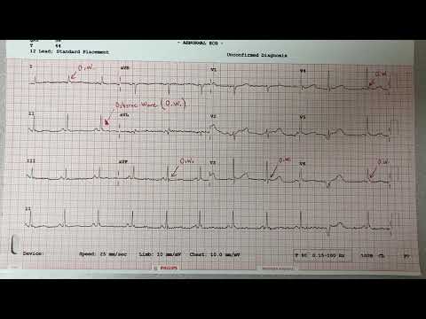OSBORNE (aka J) waves on EKG
