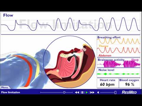 Understanding Sleep Disordered Breathing