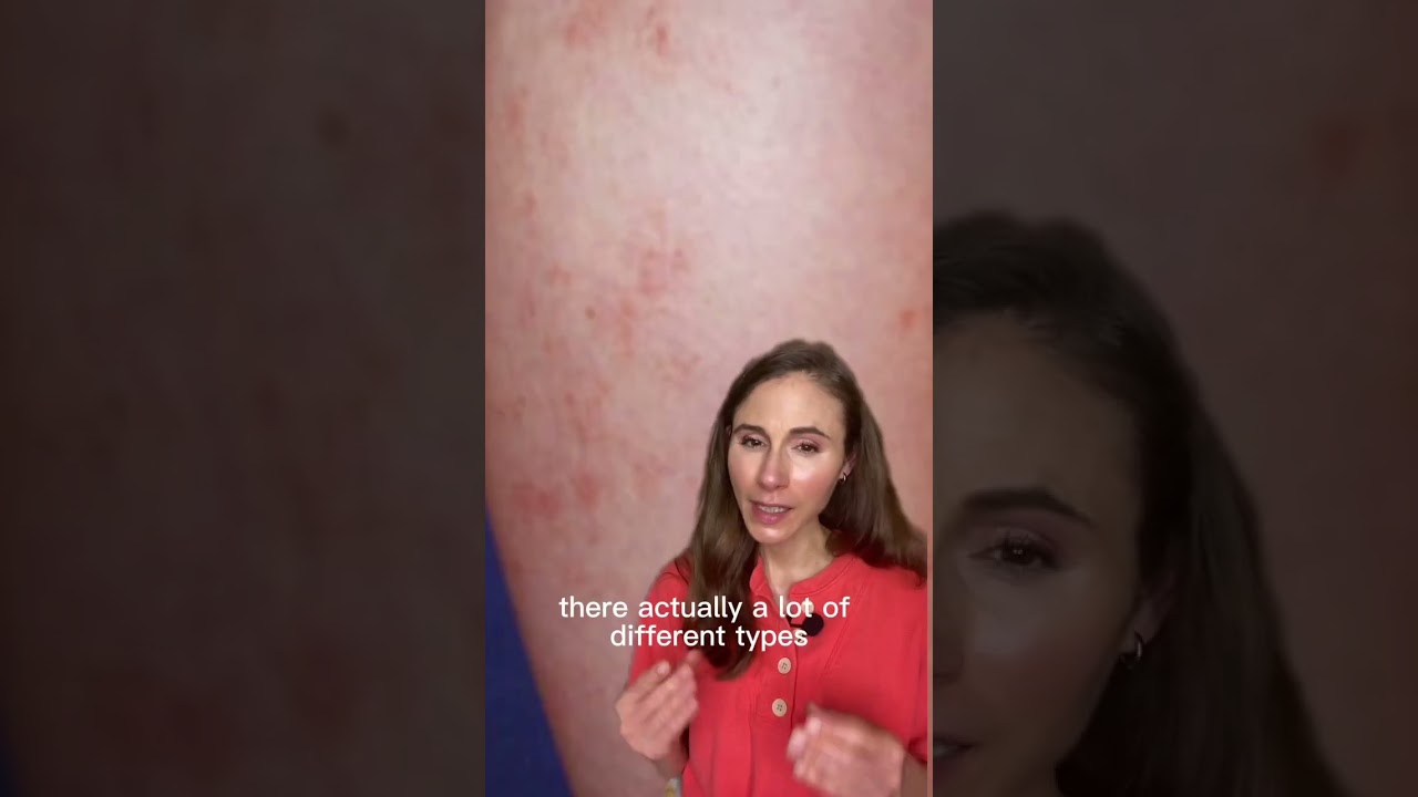 Red spots on the skin after working out #skinhealth #dermatologist