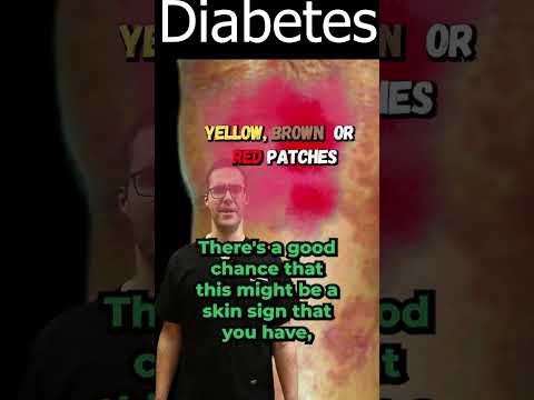 Necrobiosis Lipoidica Diabeticorum [Diabetes Symptoms & Sign]