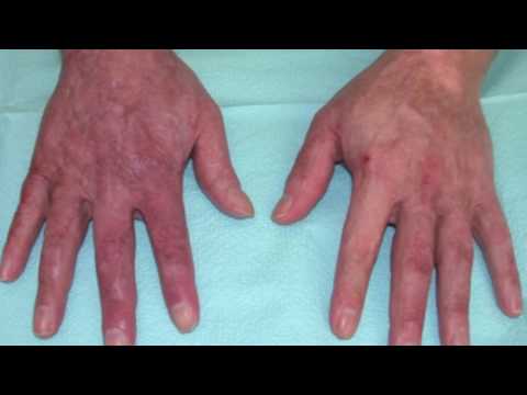 Burns 204: Draining blebs in your skin graft Video Lecture ...