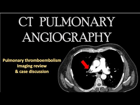 CT PULMONARY ANGIOGRAPHY |PULMONARY THROMBOEMBOLISM| Pulmonary vessels anatomyl Triple rule out CTI
