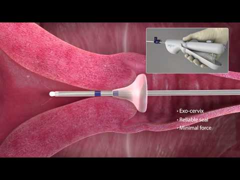 SonoSure animation