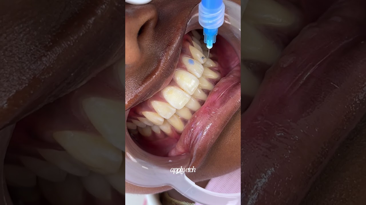 tooth gem process #toothgems #torontotoothgems