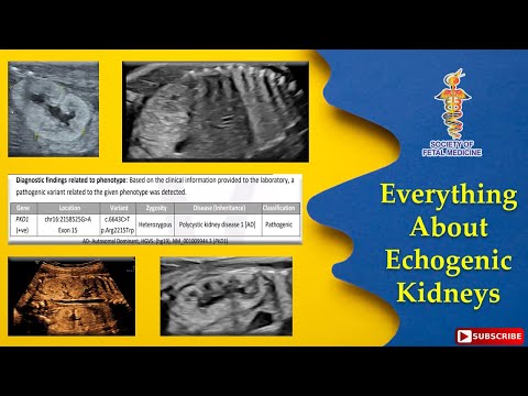 Everything about Echogenic Kidneys