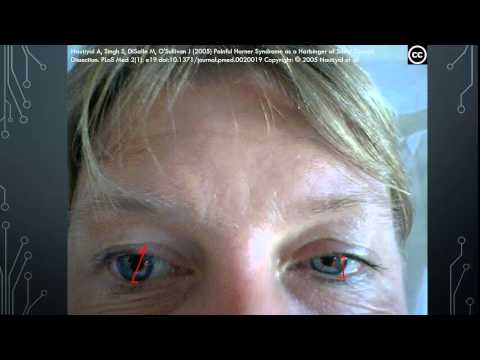 Neuro-ophthalmology: Horner Syndrome